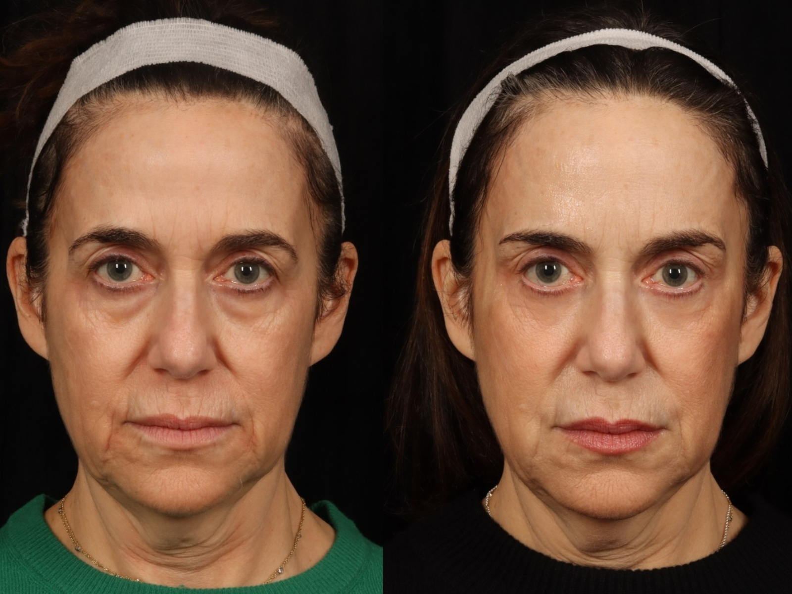 Mid Facelift Before & After Photos | W Cosmetic Surgery