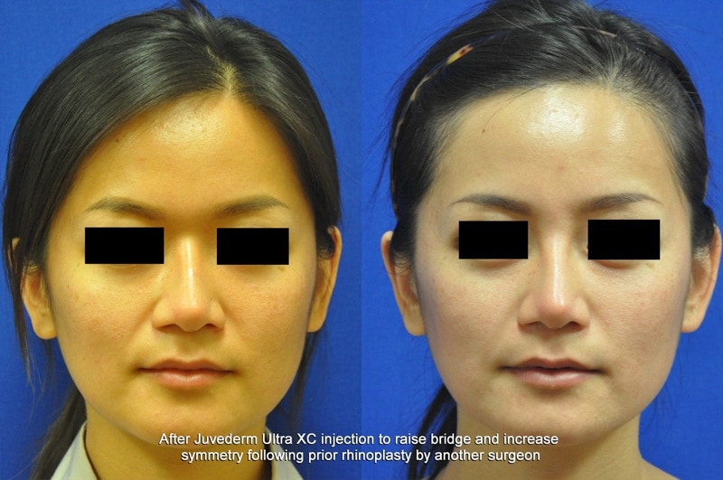 Non Surgical Rhinoplasty Before And After Photos Mehta Plastic Surgery