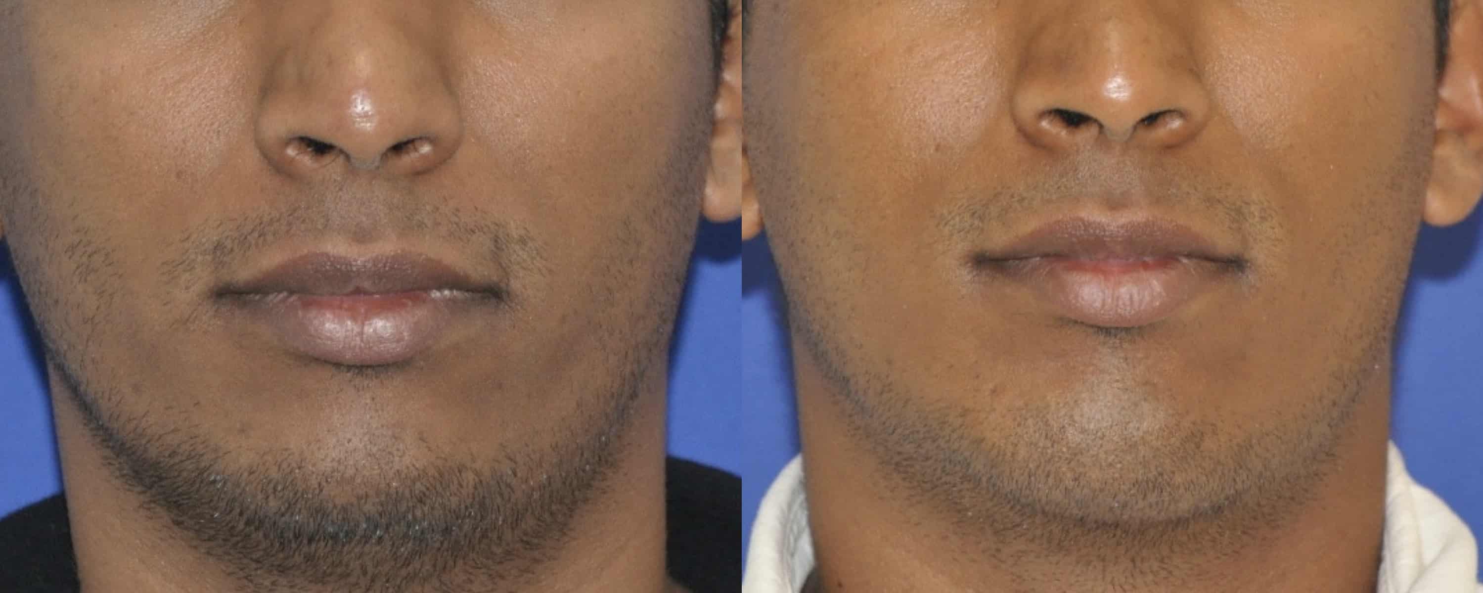 Chin Augmentation in Palo Alto, CA | Mehta Plastic Surgery