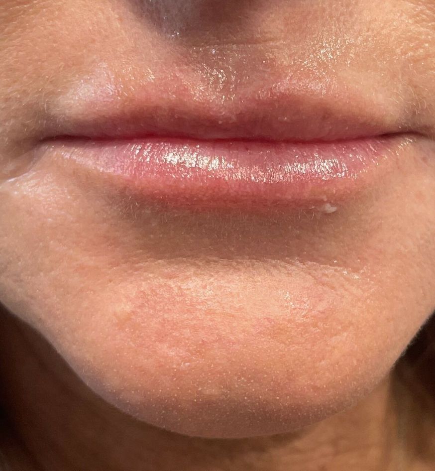 Botox Michigan | Ann Arbor Plastic Surgery