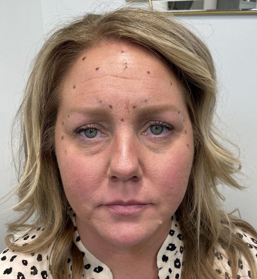 Botox Michigan | Ann Arbor Plastic Surgery