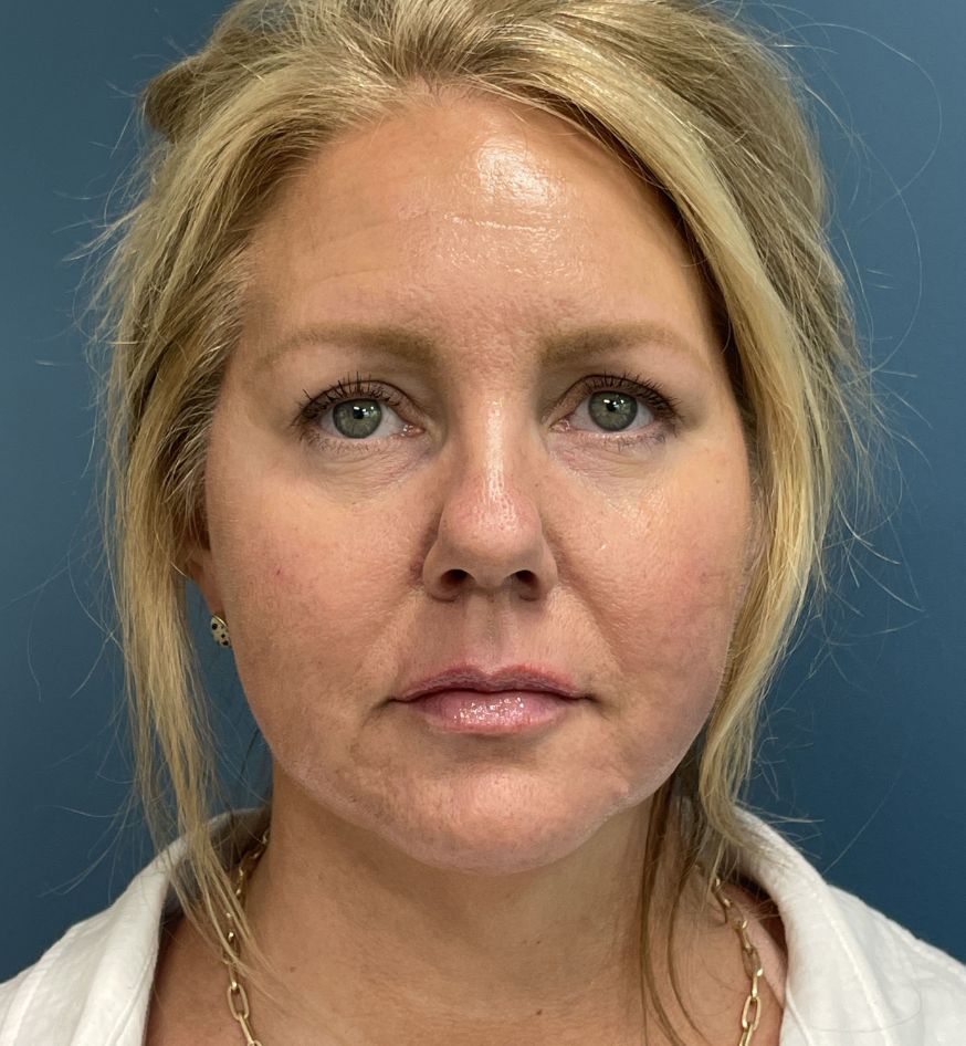 Botox Michigan | Ann Arbor Plastic Surgery