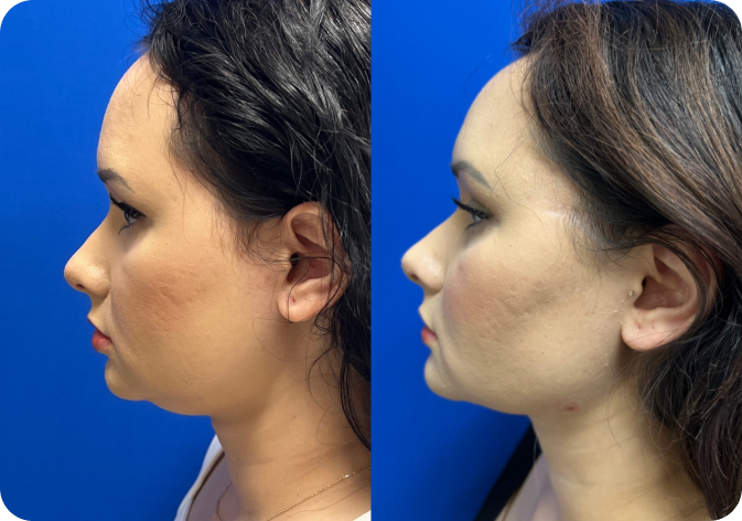 Chin Augmentation in Miami | Chopra Plastic Surgery