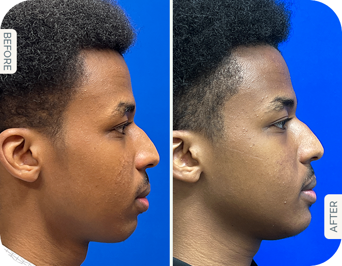 Chin Augmentation in Miami | Chopra Plastic Surgery