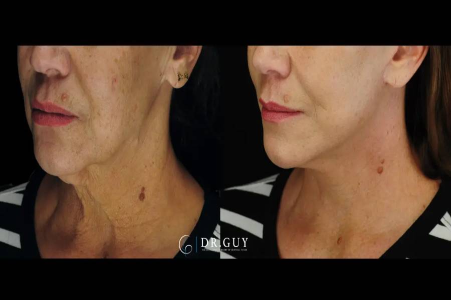 Understanding How a Mini Facelift Works – Facial Plastic Surgery of ...