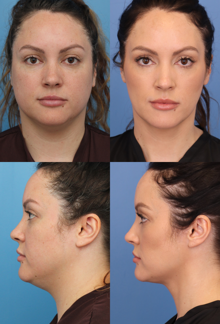 Neck Liposuction Before & After Photos | Dr. Chasan | Ranch & Coast ...