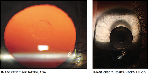 Pitfalls for Corneal Inlays in Presbyopic Patients | Blog & News ...