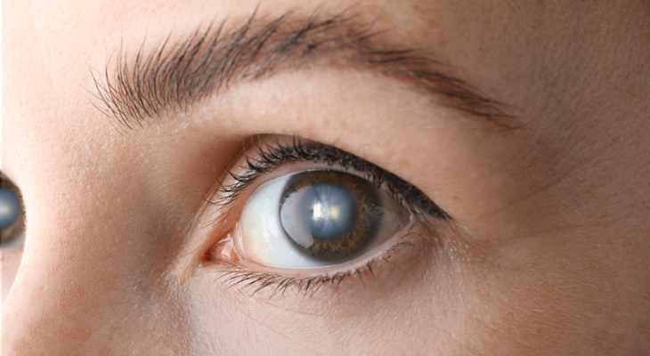 January Newsletter: The Three Most Common Types of Cataracts ...