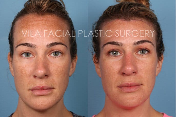 Forehead Reduction Gallery | Vila Facial Plastic Surgery