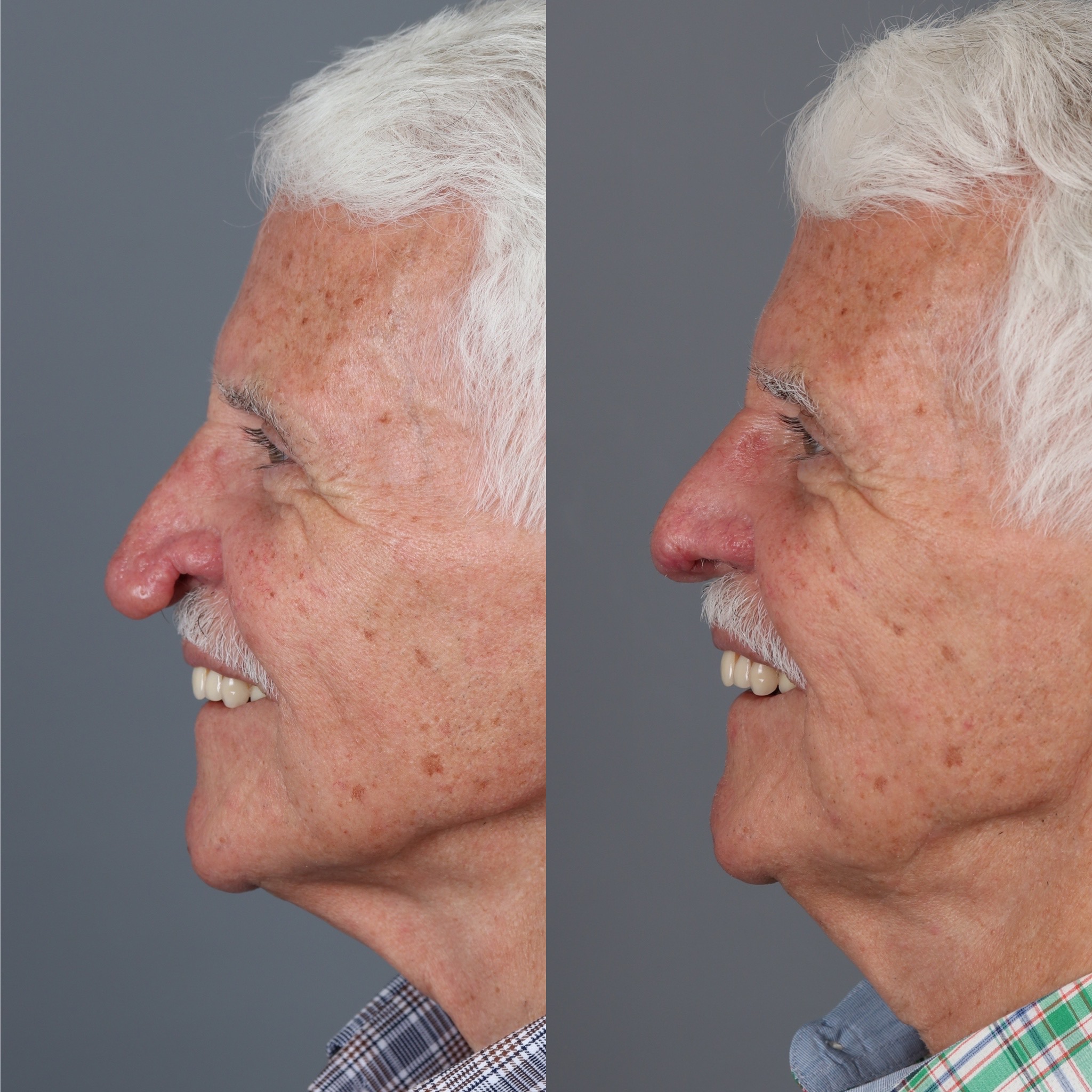Rhinophyma Gallery | Vila Facial Plastic Surgery