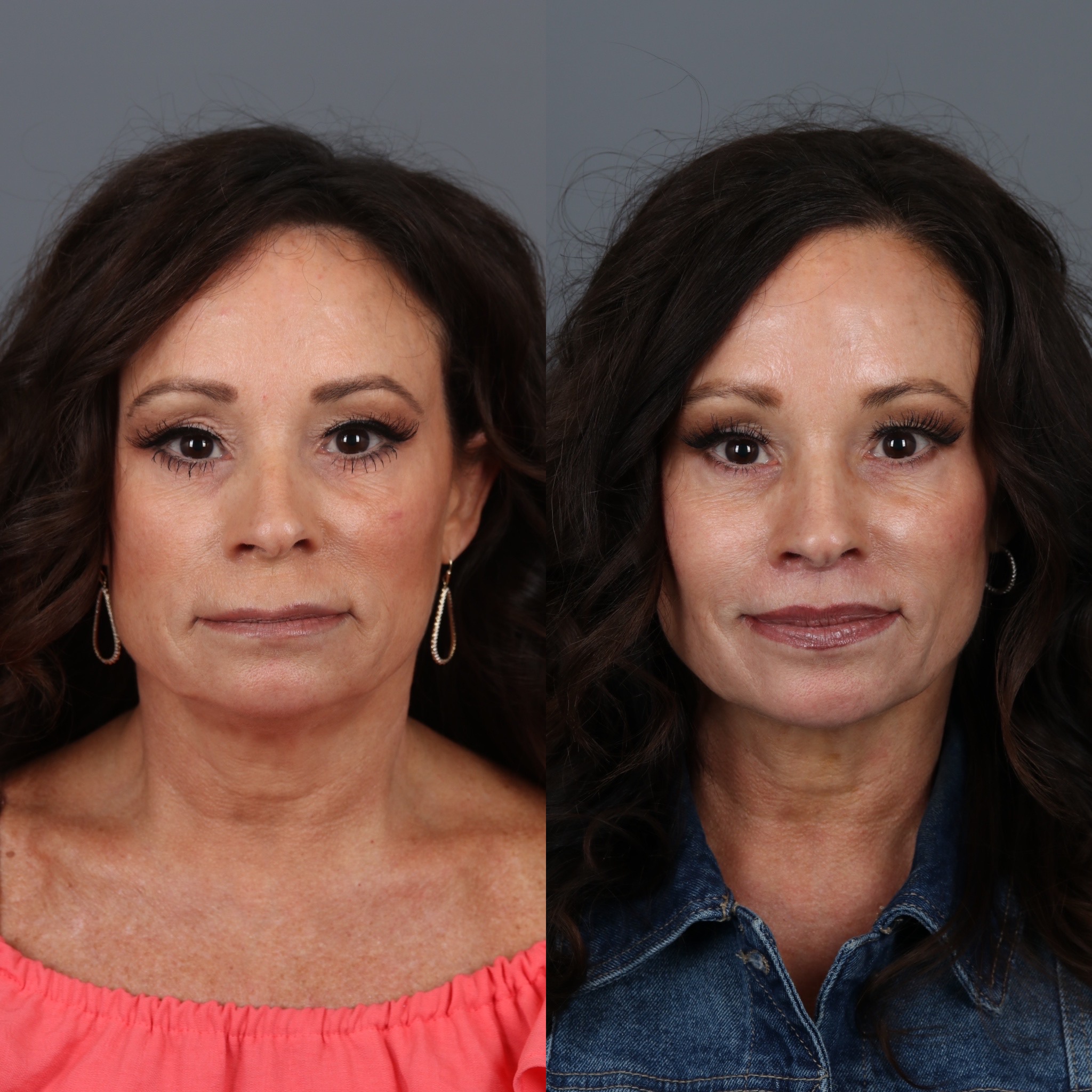 Lip Lift Before & After Photos | The Vila Institute for Plastic Surgery