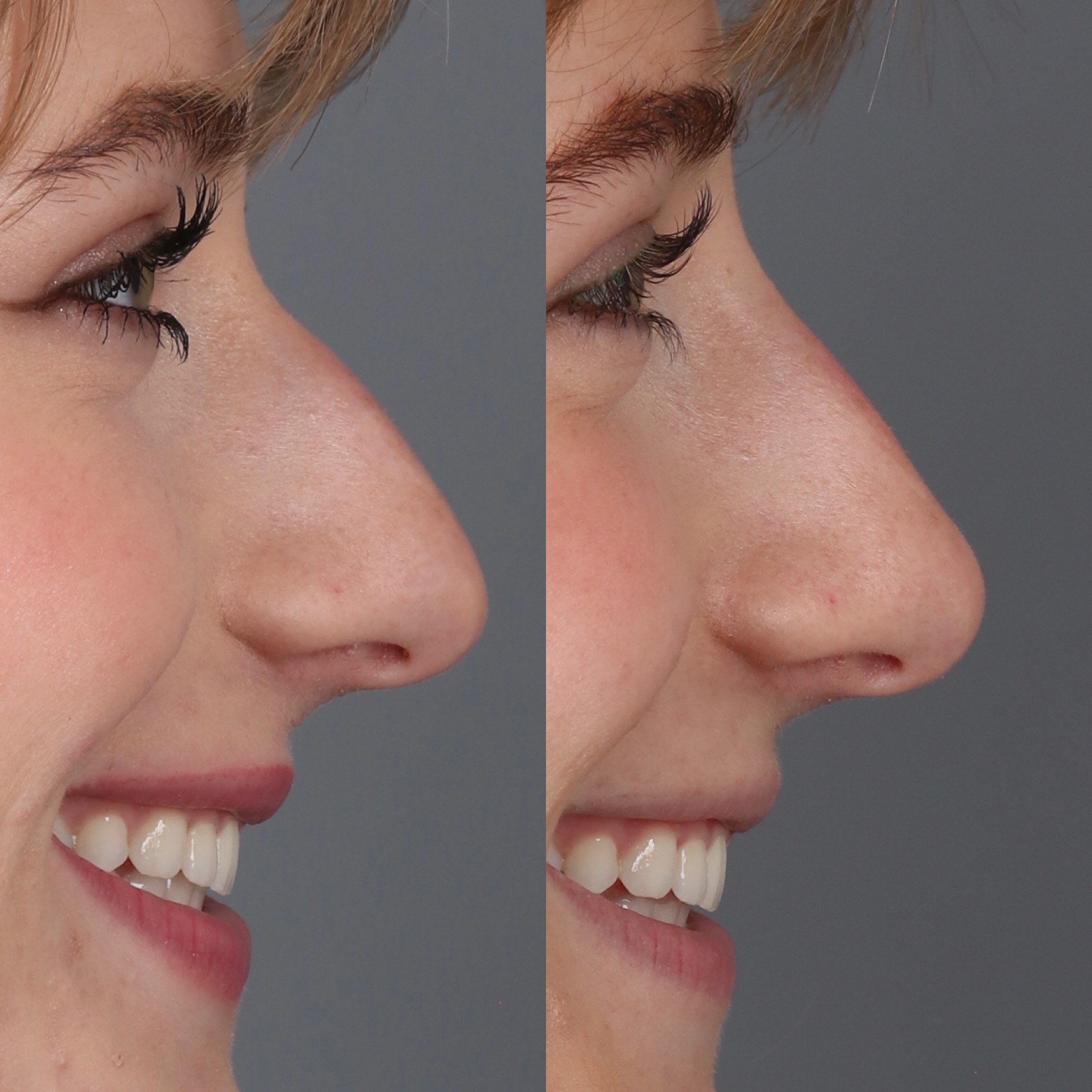 Liquid Rhinoplasty Before & After Photos | The Vila Institute for ...