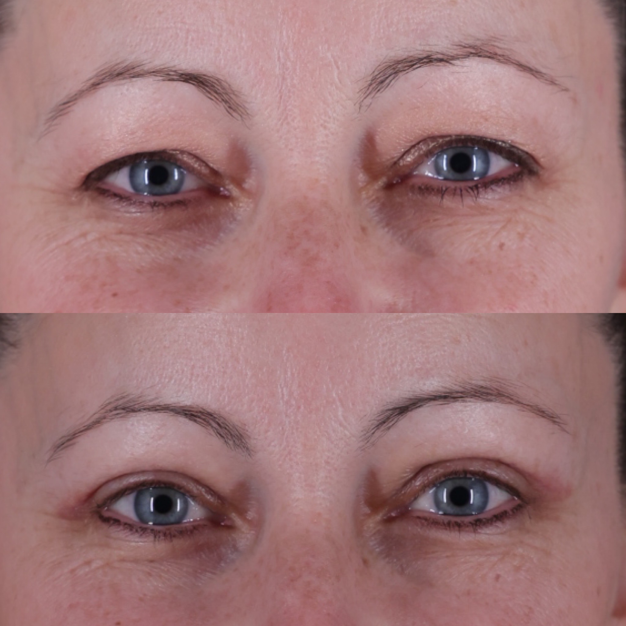 Upper Blepharoplasty Before & After Photos | The Vila Institute for ...