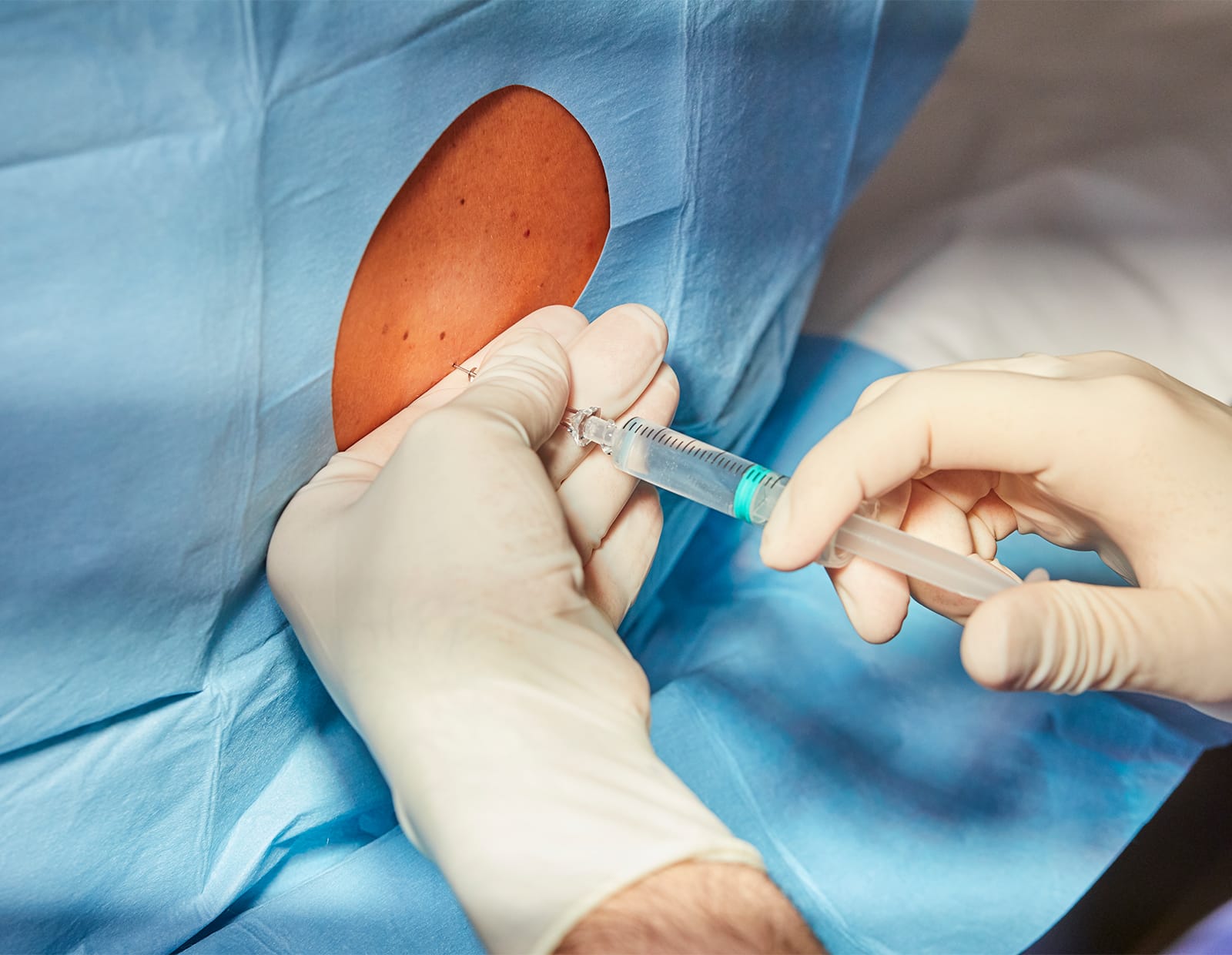 Epidural Injection in New Jersey | Gerling Spine Care and Research ...