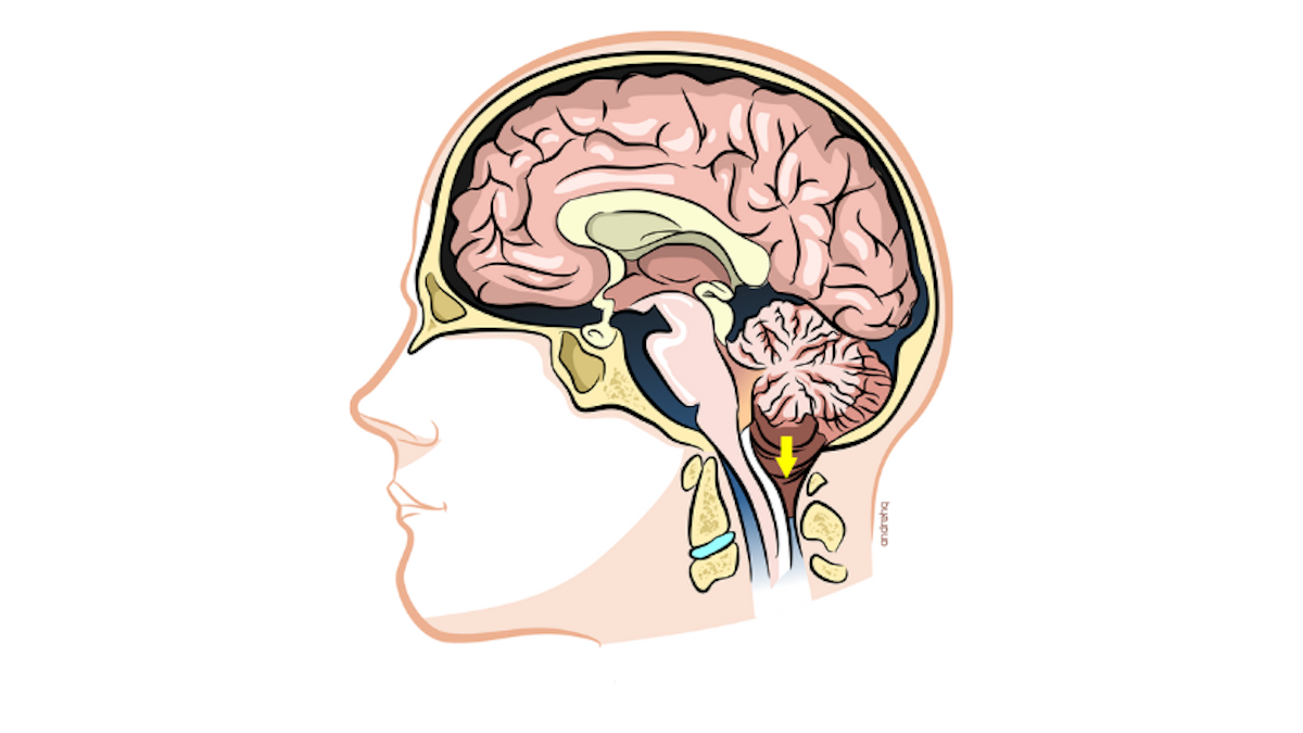chiari-malformation