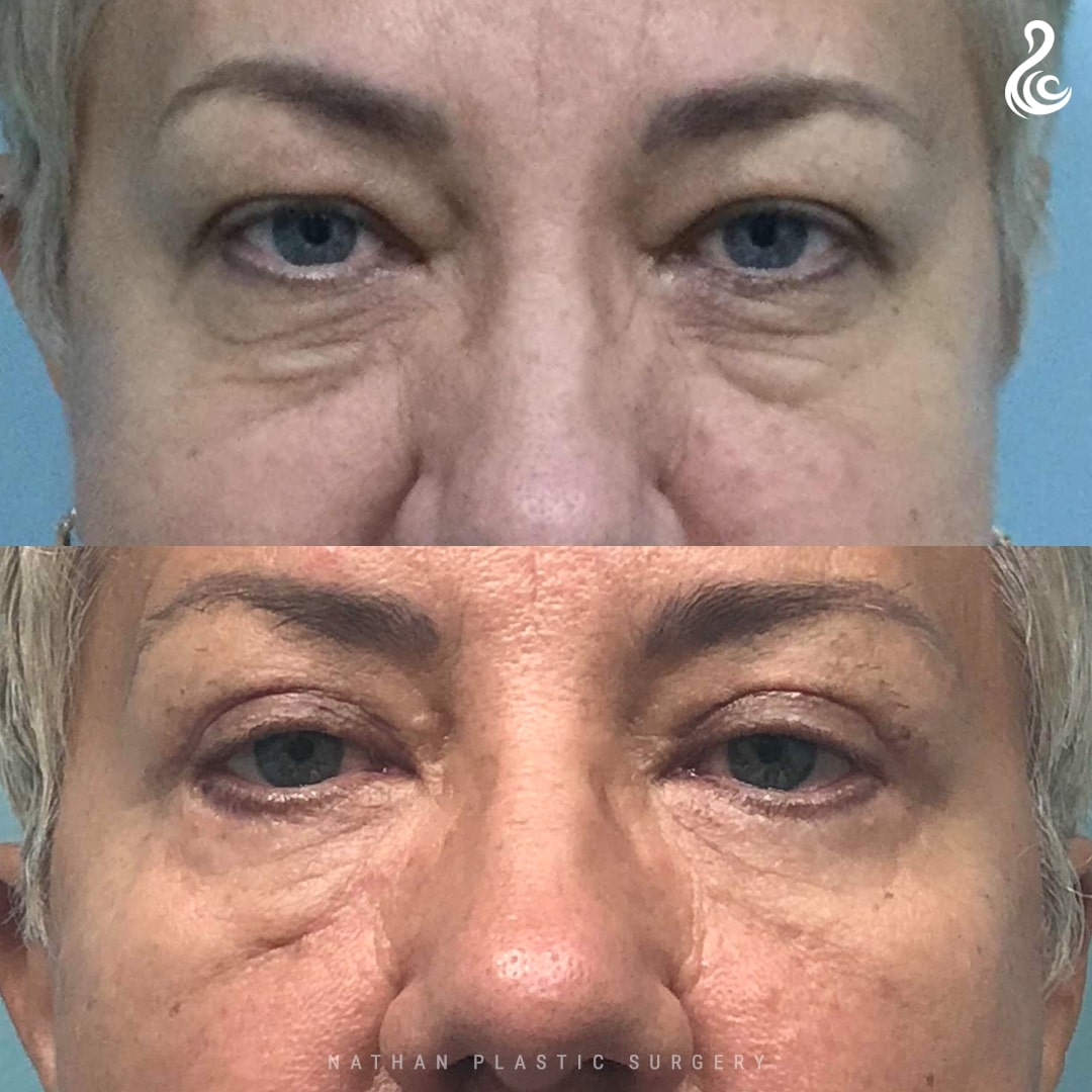 Eyelid Surgery Miami | Blepharoplasty in Miramar, FL | The Nathan Clinic