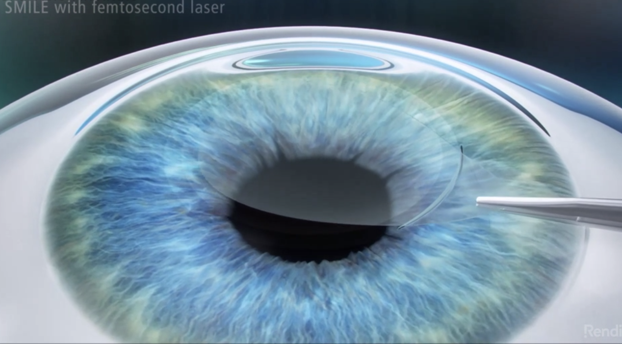 What is SMILE Vision Correction? - Chu Vision Institute