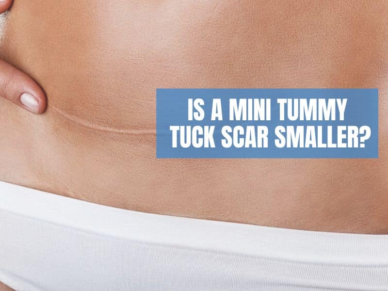 Is a Mini Tummy Tuck Scar Smaller? | Galanis Plastic Surgery