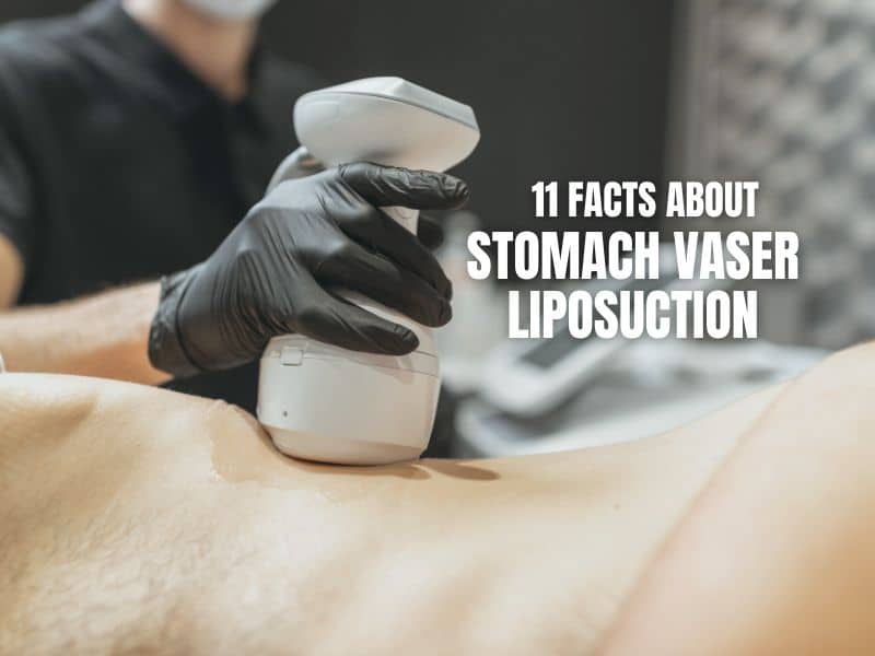 11 Facts About Stomach VASER Liposuction l Dr. Galanis