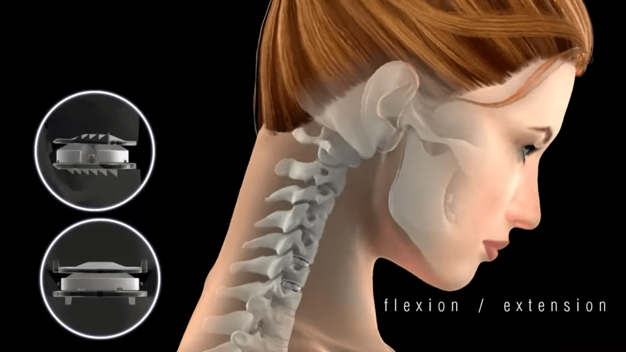 Mobi-C Cervical Disc Replacement & Recovery NYC | Jonathan R. Stieber, MD