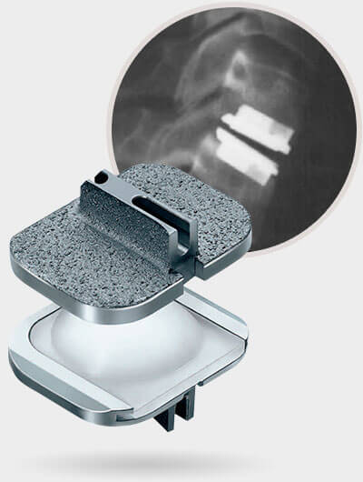 Prodisc-C New Jersey | Prodisc-C NJ | Jonathan R. Stieber, MD