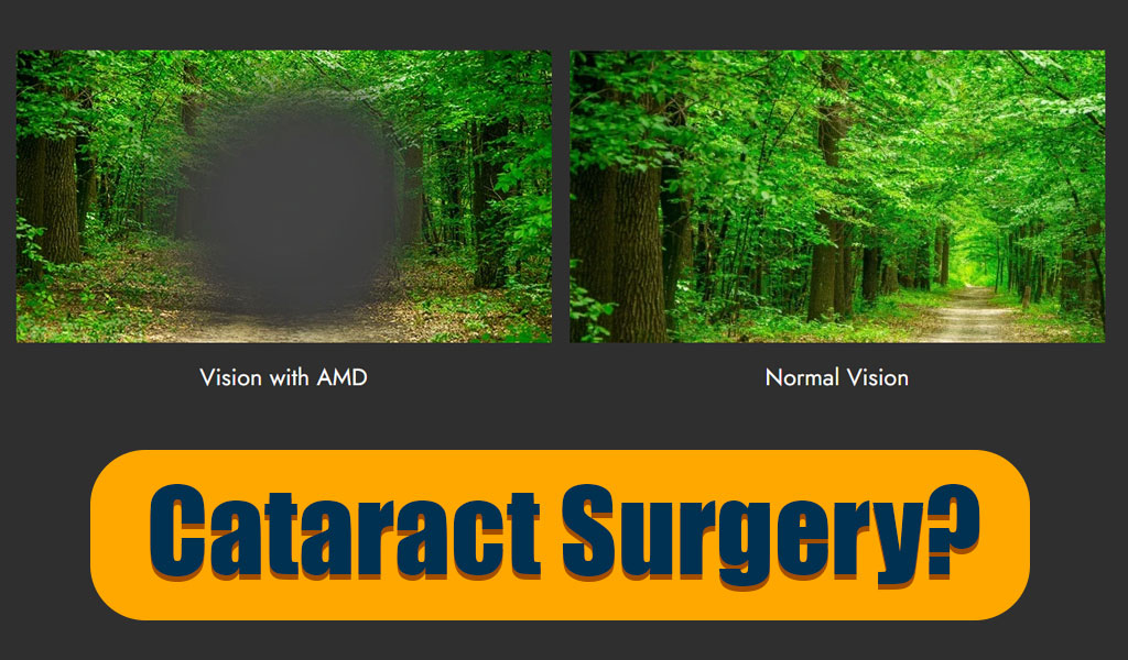 Can cataract surgery improve my vision if I have Macular degeneration?