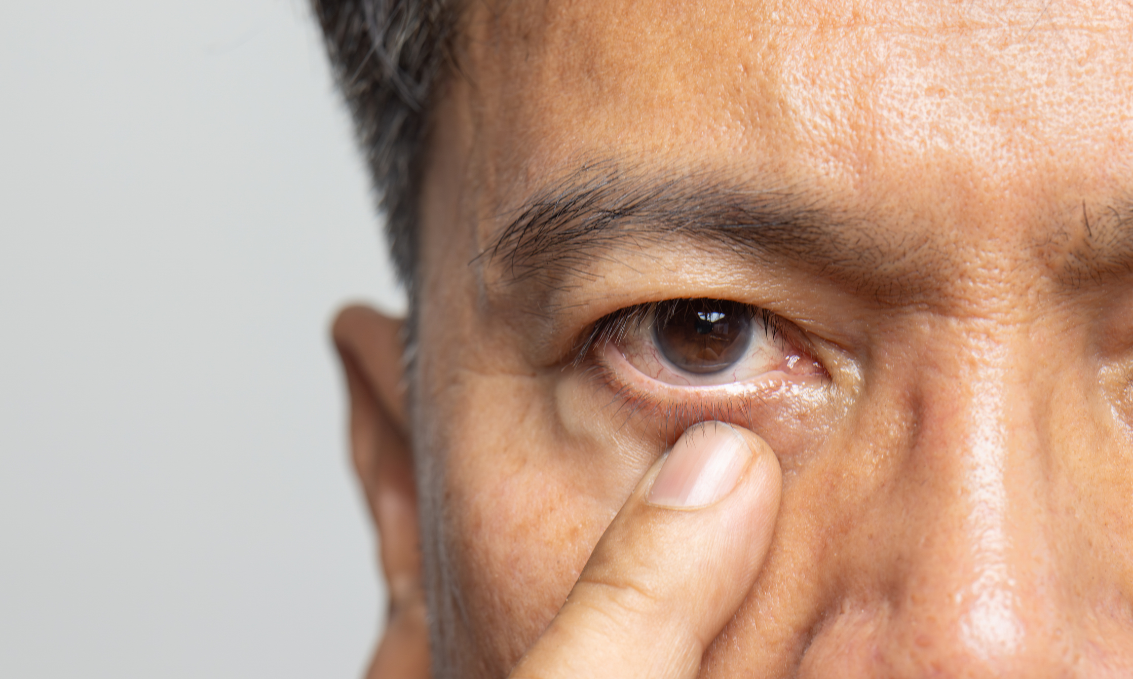 New Breakthroughs in Dry Eye Treatment: 5 Innovative Approaches to ...