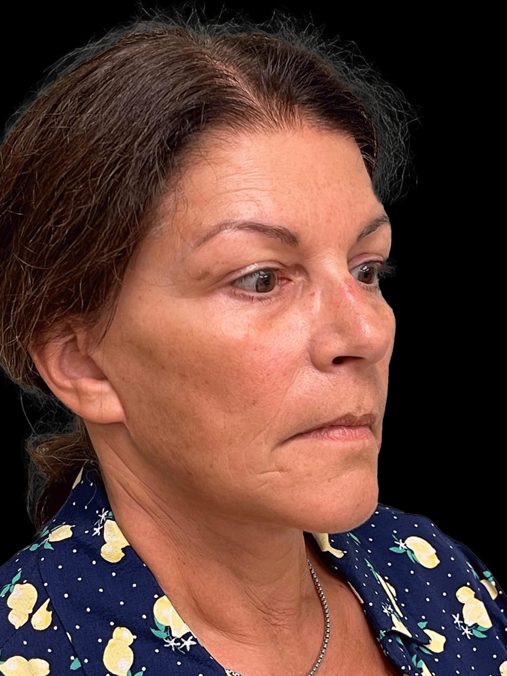 Patient 184962 | Facelift Before & After Photos | Connecticut Facial ...