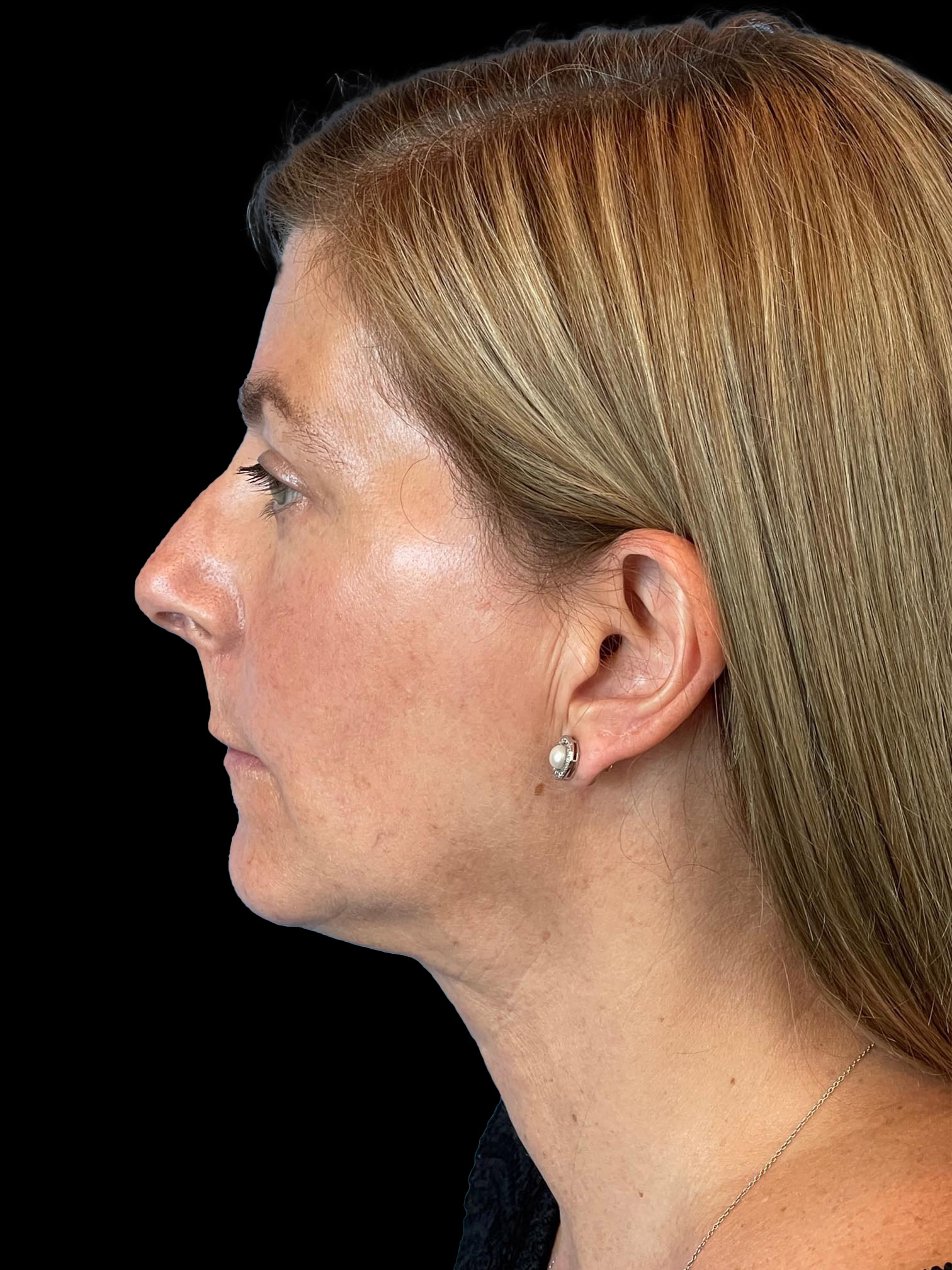 Patient 411895 | Necklift Before & After Photos | Connecticut Facial ...