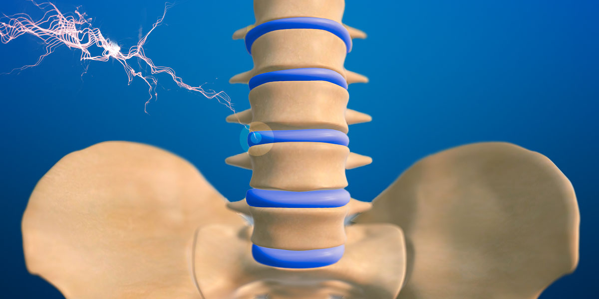 What Is an Intracept Procedure? - NYSI
