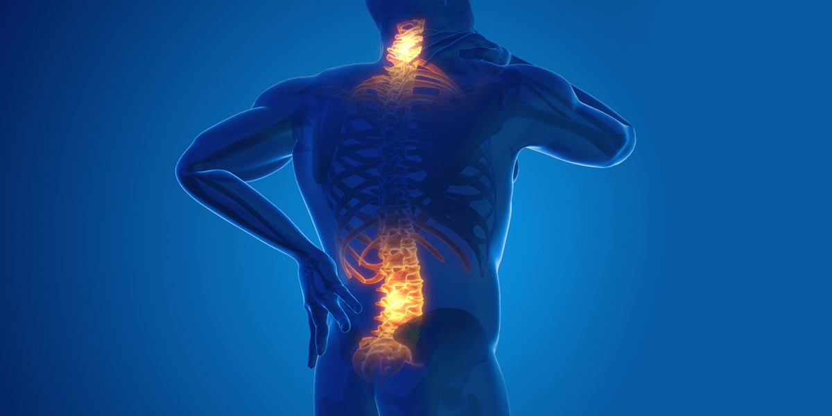 What is Lordosis? Key Insights and Care Tips