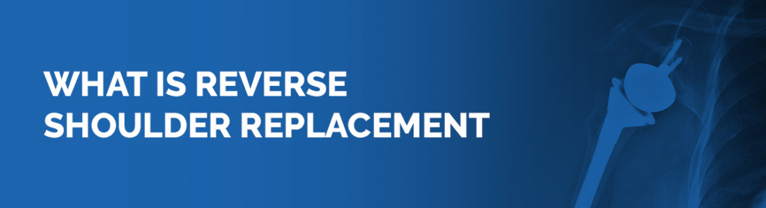 What Is Reverse Shoulder Replacement | Blog | NYSI