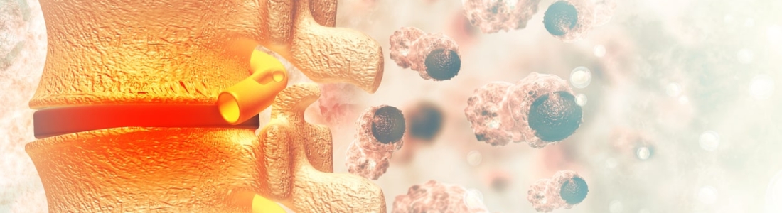 What Is A Spinal Tumor? - NYSI