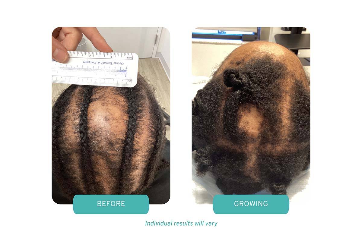 Combination Therapy for Scarring Alopecia in New York City, NY