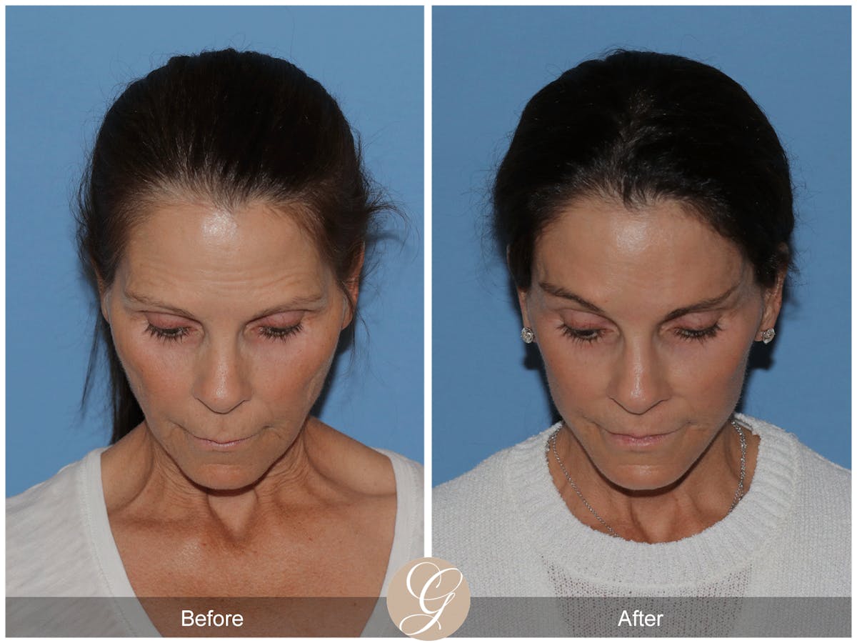 Patient 224429 | Deep Plane Facelift Before & After Photos | Dr. Kevin ...