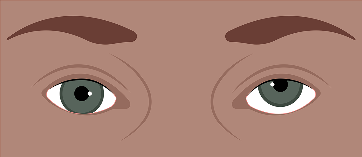 Infant Hypertropia in Queens and Nassau County | The Pediatric Eye Center