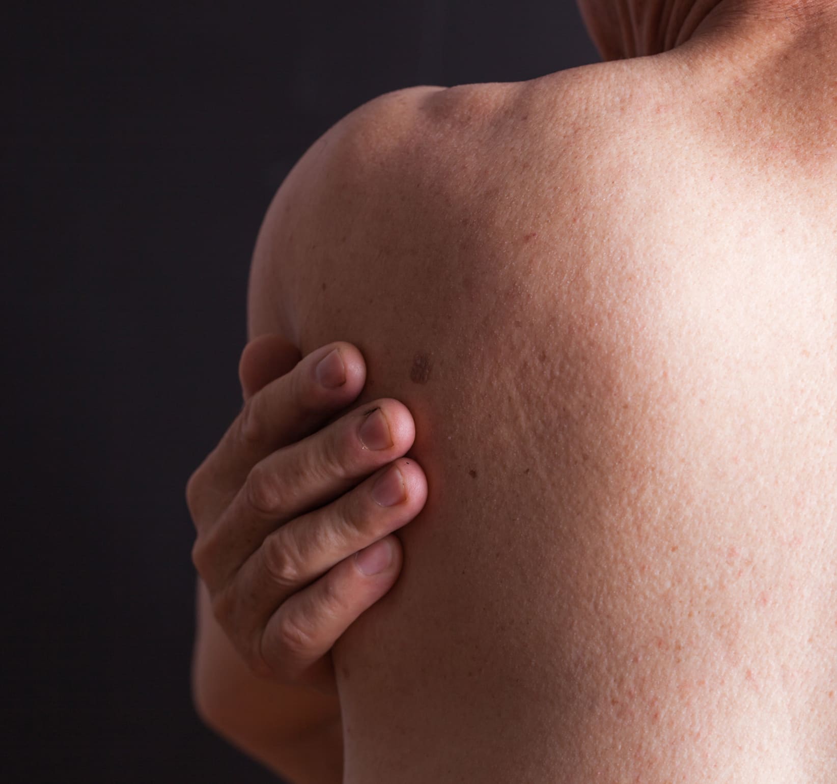 Skin Tag Removal in Lawrenceville, Suwanee, & Dacula, GA | Center for ...