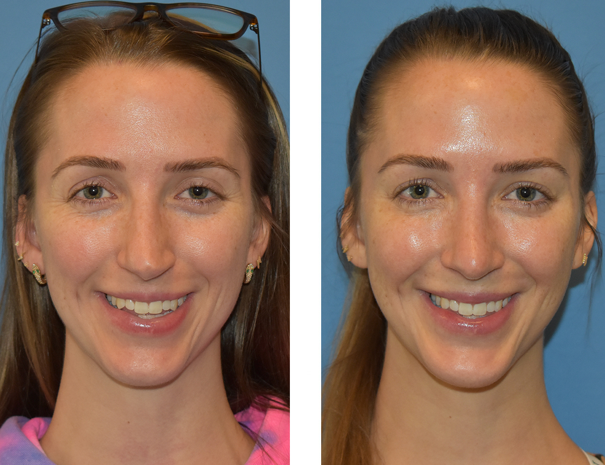 Deviated Septum Surgery Before And After