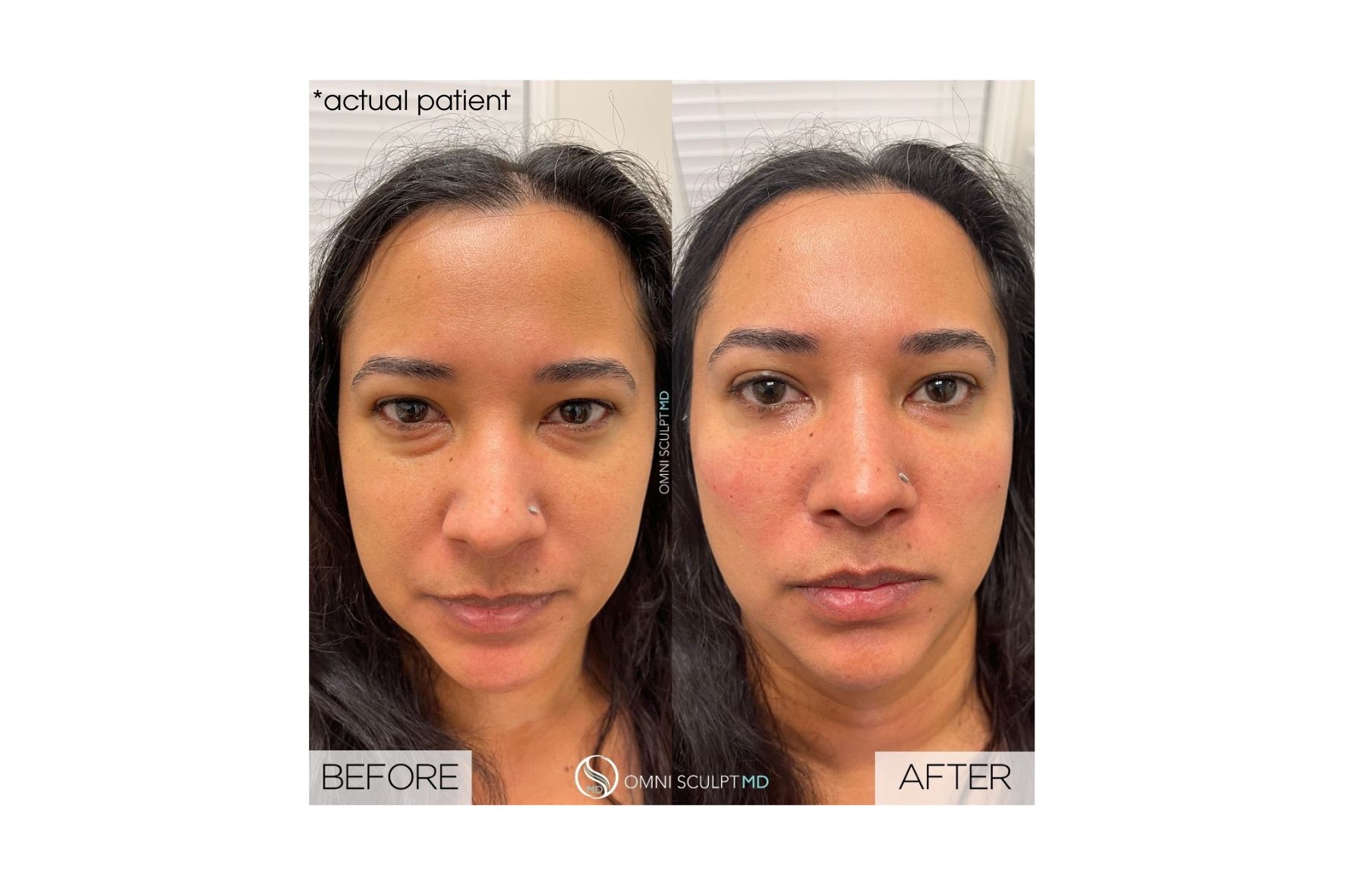 PRP vs. Under Eye Filler: Revitalizing Your Look | OMNI SCULPT