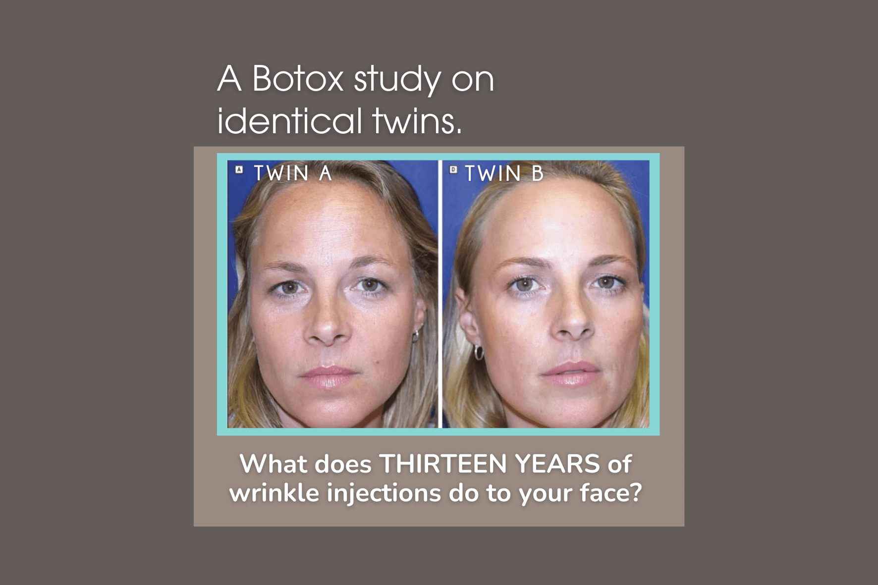 Preventative Botox in Twins Study | OmniSculpt