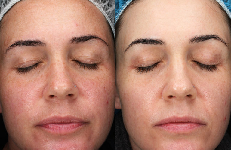 Sciton MOXI Laser Treatments in Dallas, TX - OMNI SCULPT MD