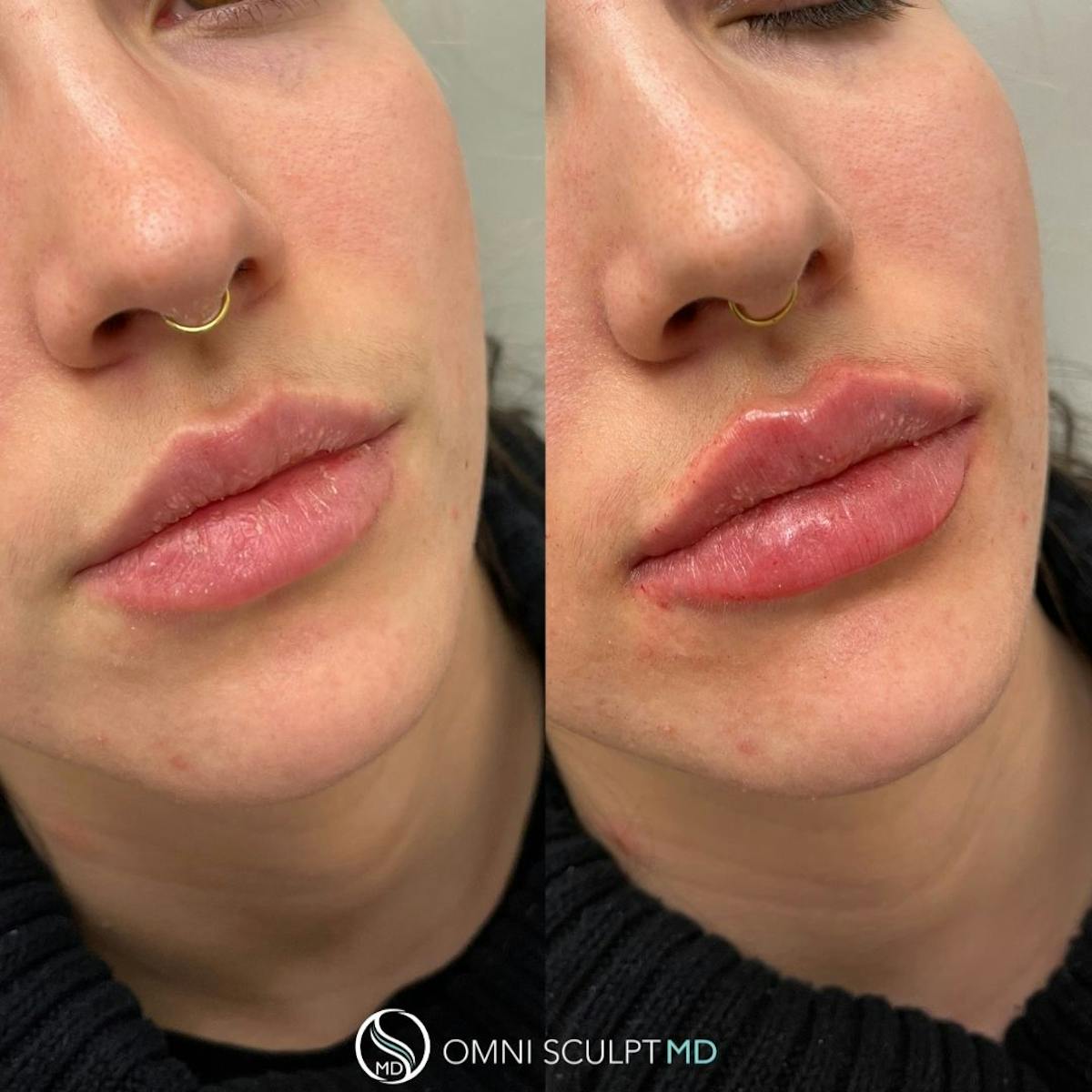 Patient 904141 | Lips Before & After Photos | Omni Sculpt MD