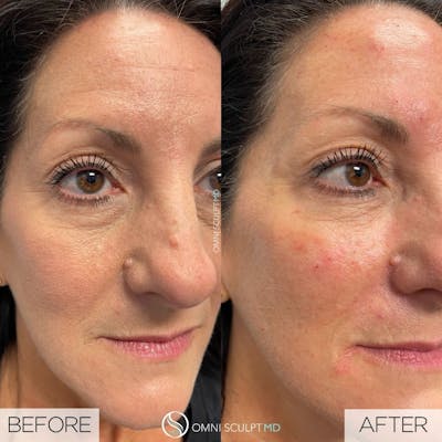 Under Eye & Cheeks Before & After Photos | Omni Sculpt MD