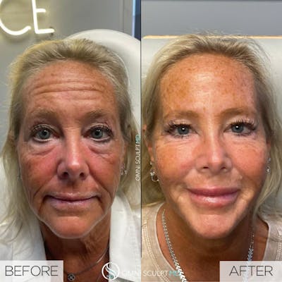 Full Facial Rejuvenation Before & After Photos | Omni Sculpt MD