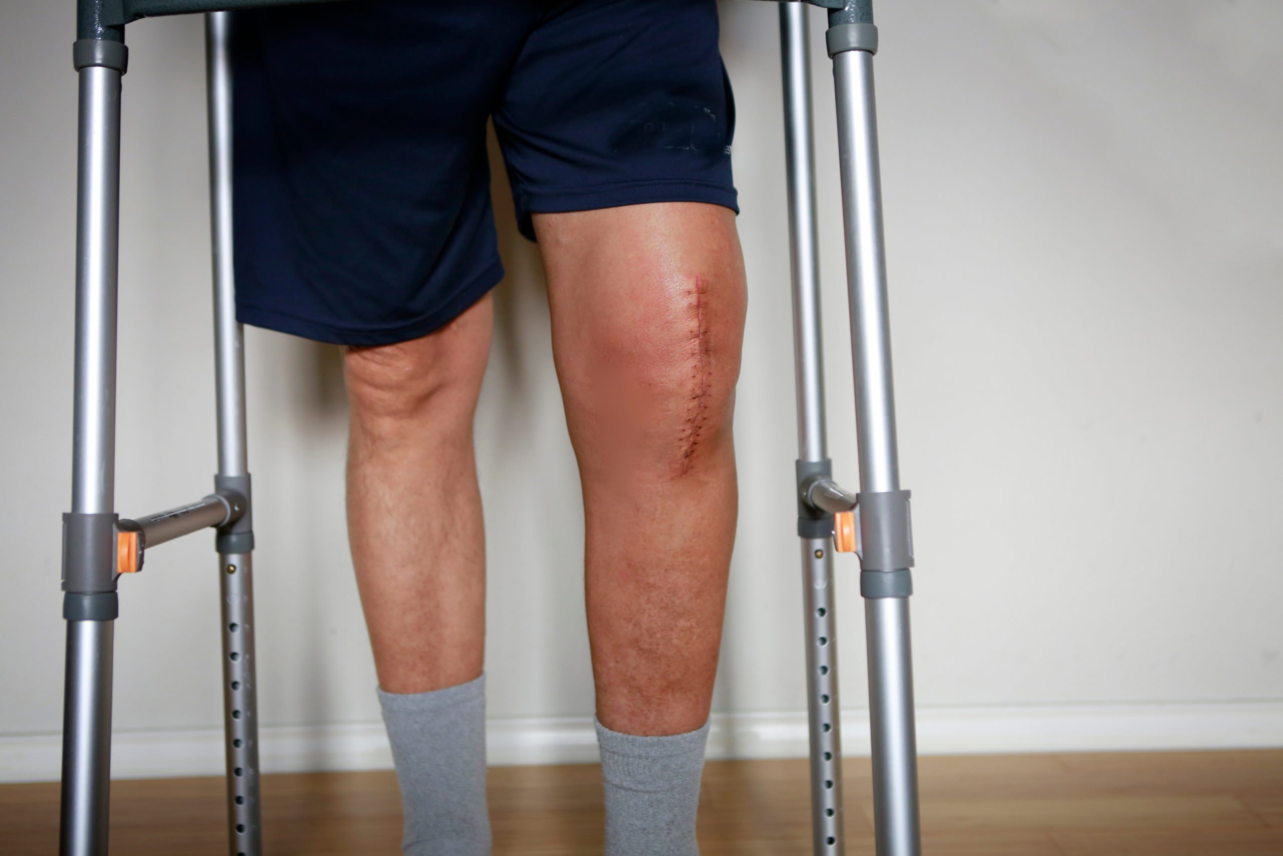 Knee Replacement Recalls: Everything You Need to Know