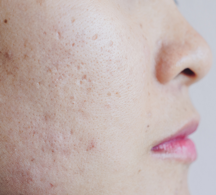 Scar Revision Birmingham AL | Rousso Adams Facial Plastic Surgery