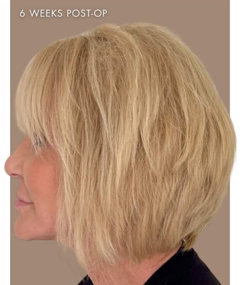 Neck Lift Birmingham Al Neck Lift In Montgomery Al