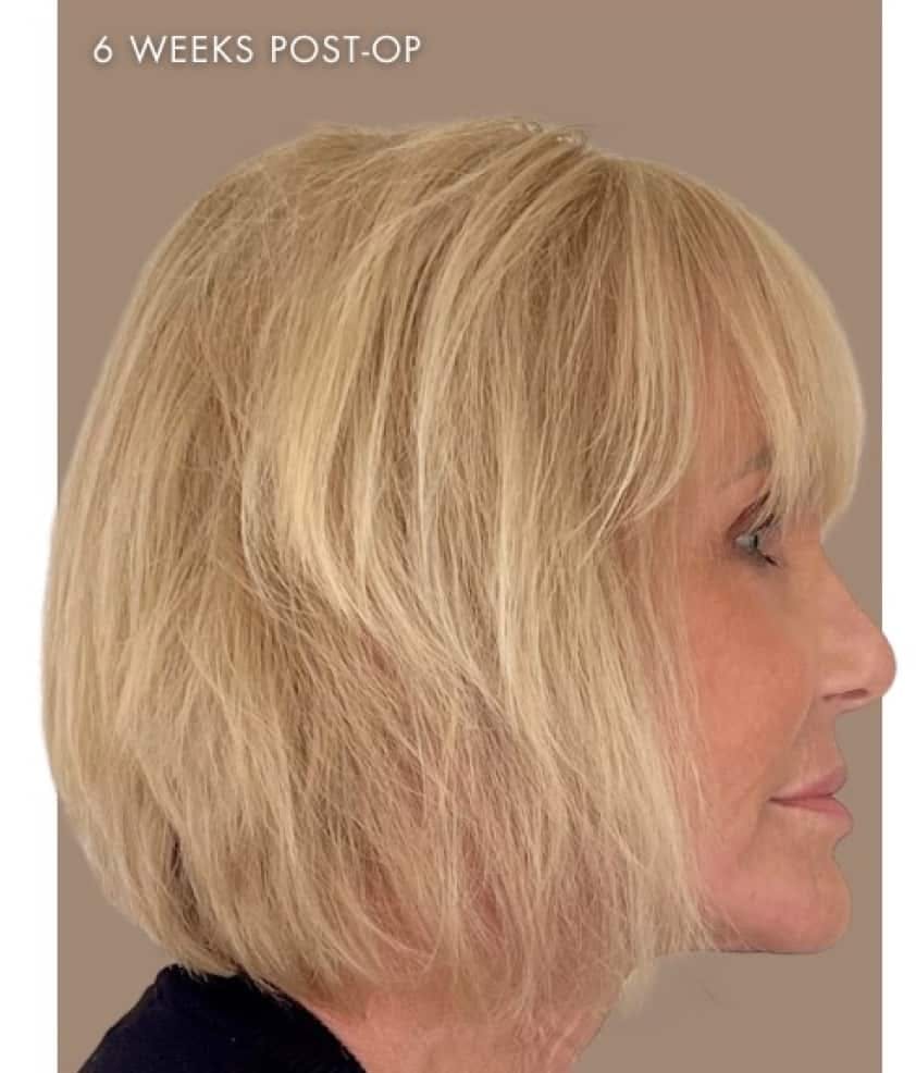 Neck Lift Birmingham Al Neck Lift In Montgomery Al