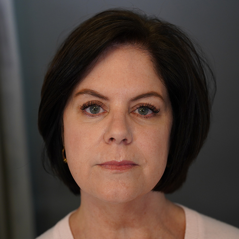 Patient 402071 | Blepharoplasty Before & After Photos | Refine Facial ...