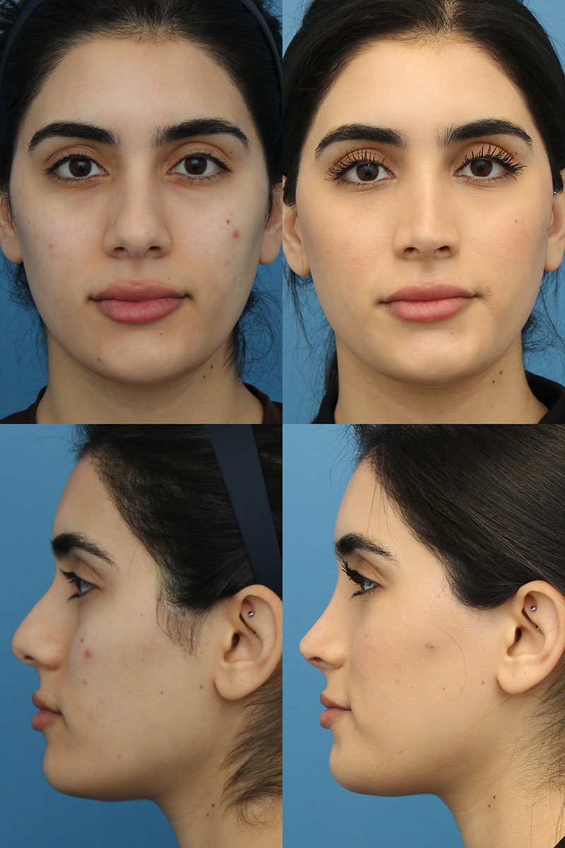 Rhinoplasty Before And After Bulbous Tip